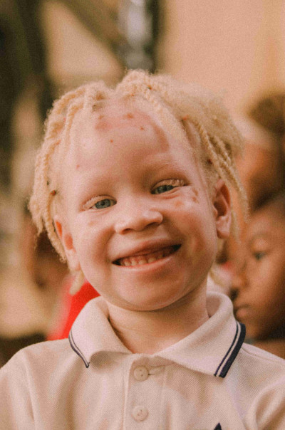 Manusia Albino, Memilih Hak Asasi Manusia atau Tradisi? | NNC Netralnews